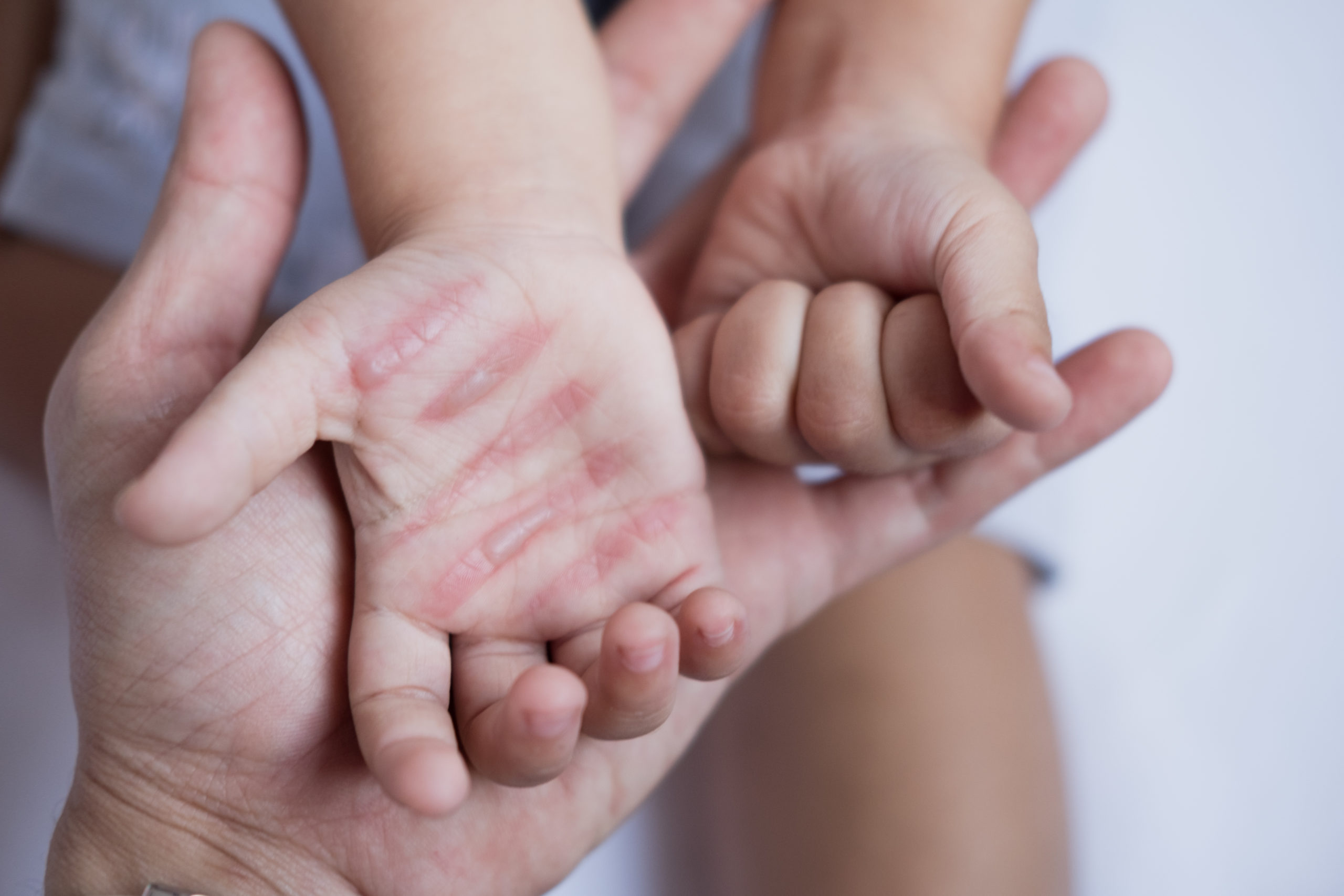 How to treat first degree minor burn | Kleiman Healthcare Services